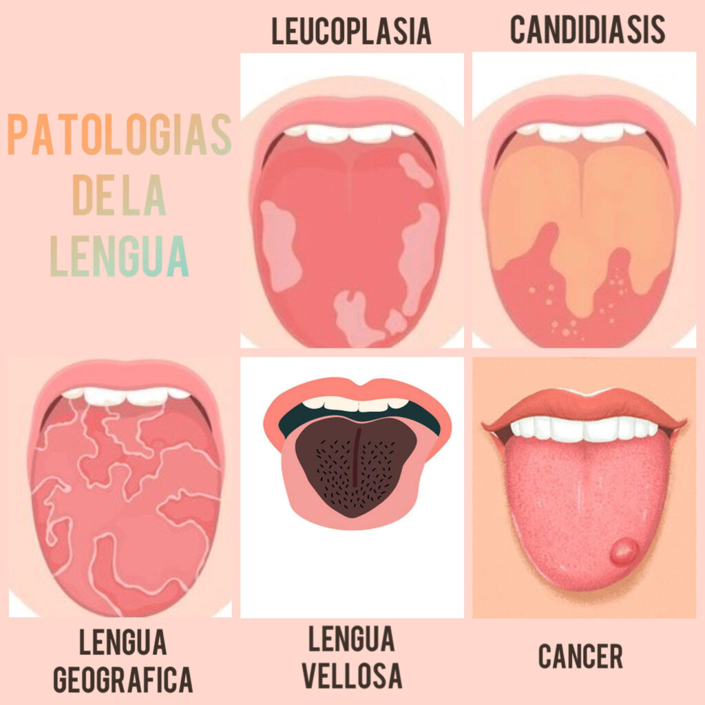 LA LENGUA Y SU SALUD - Clínica Dental Puerto Sagunto Larrazabal